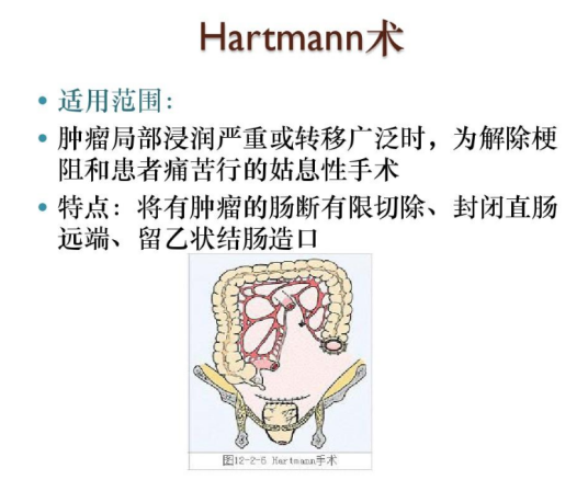 hartmann手术_百度百科