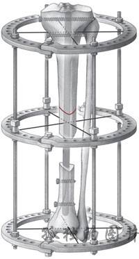 Ilizarov技术_百度百科