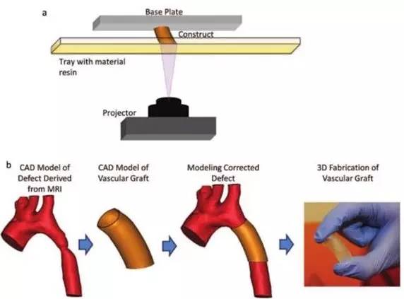 3D打印血管：治疗先天性心脏病_百科TA说
