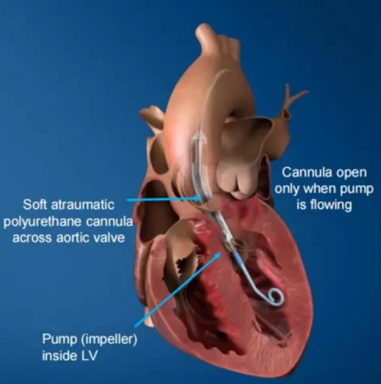 Impella_百度百科