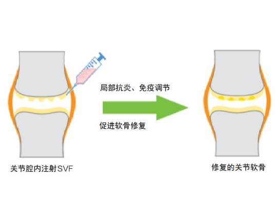 SVF_百度百科