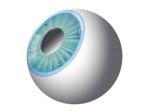 ICL手术_百度百科