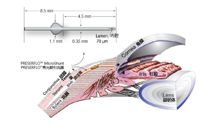 PRESERFLO MICROSHUNT_百度百科