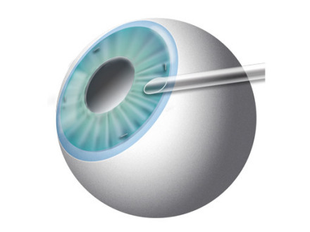 ICL手术_百度百科