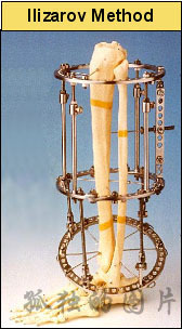 Ilizarov技术_百度百科