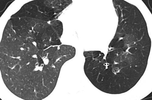 Swyer-James综合征_百度百科
