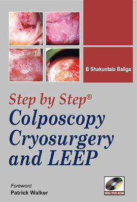 Step-by-step Colposcopy, Cryosurgery, and LEEP_百度百科